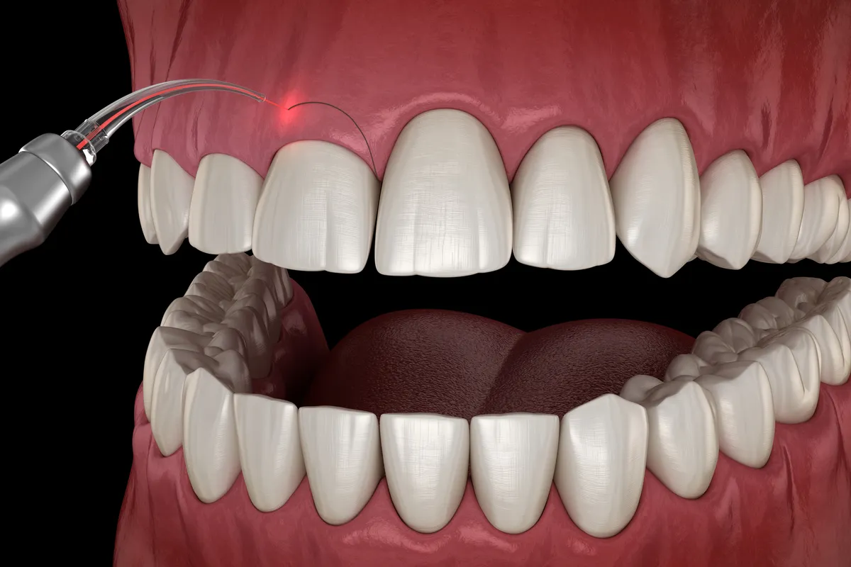 Gingivectomy: When Treatment is Necessary, Costs & More | NewMouth