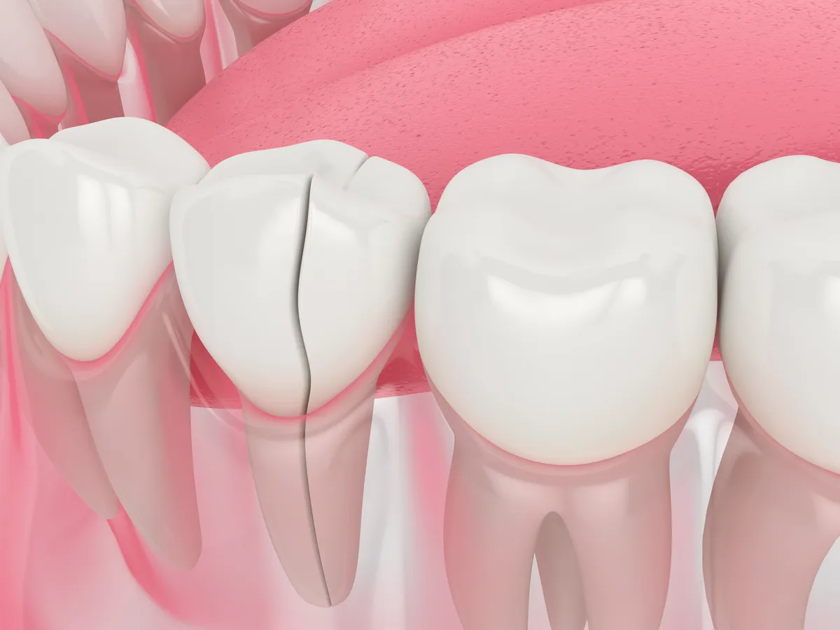 Cracked Teeth: 5 Types of Fractures, Causes & Symptoms – NewMouth
