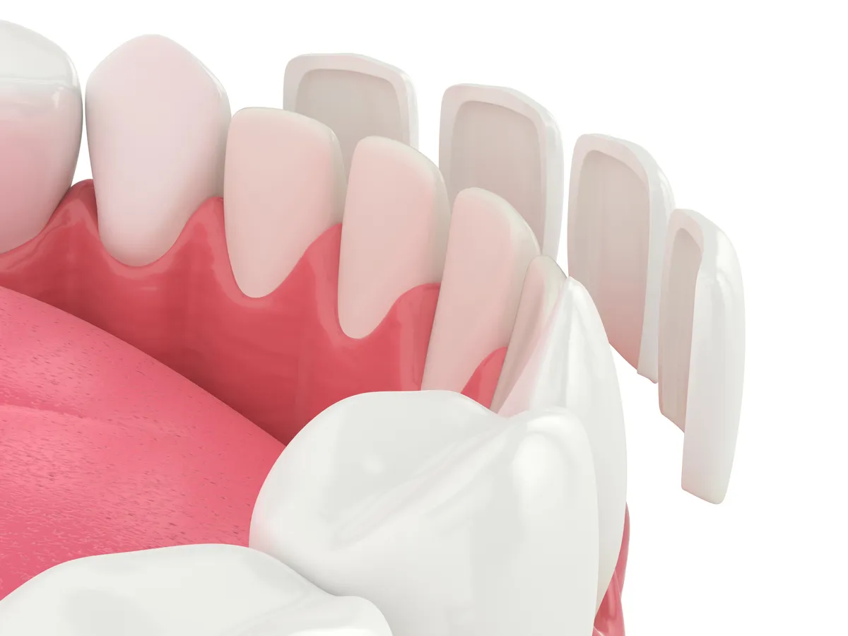 How Much Do Veneers Cost? - Financing Options & Alternatives | NewMouth