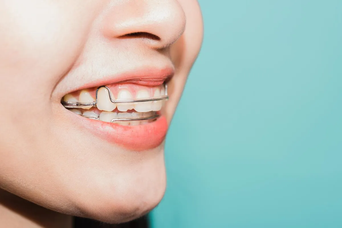 Permanent Retainers - Pros, Cons, & Costs | NewMouth
