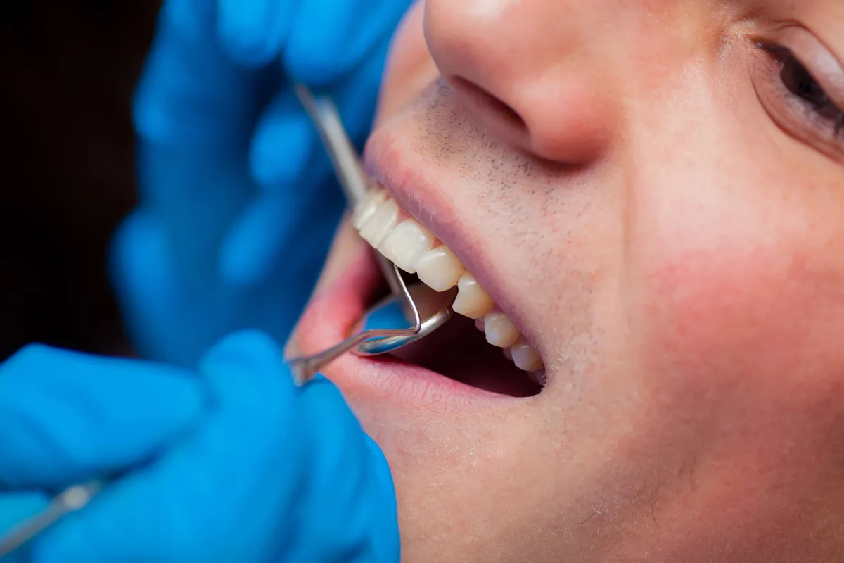 Calcium Buildup on Teeth - Causes, Treatments & Prevention | NewMouth
