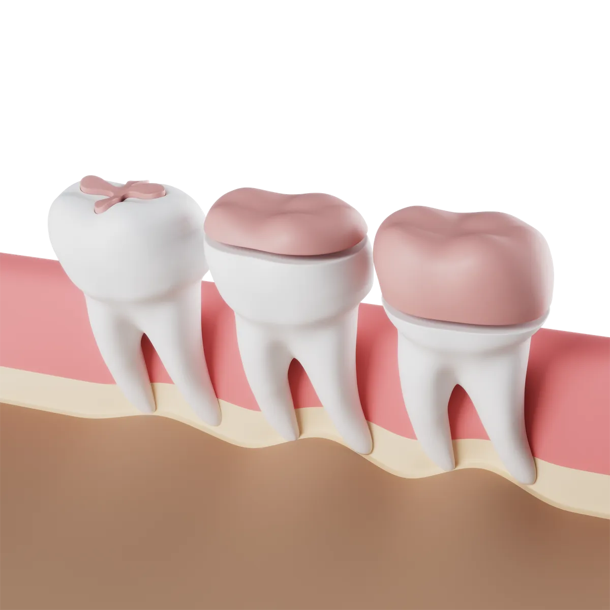 What are Inlays and Onlays? Causes for Treatment & Costs – NewMouth