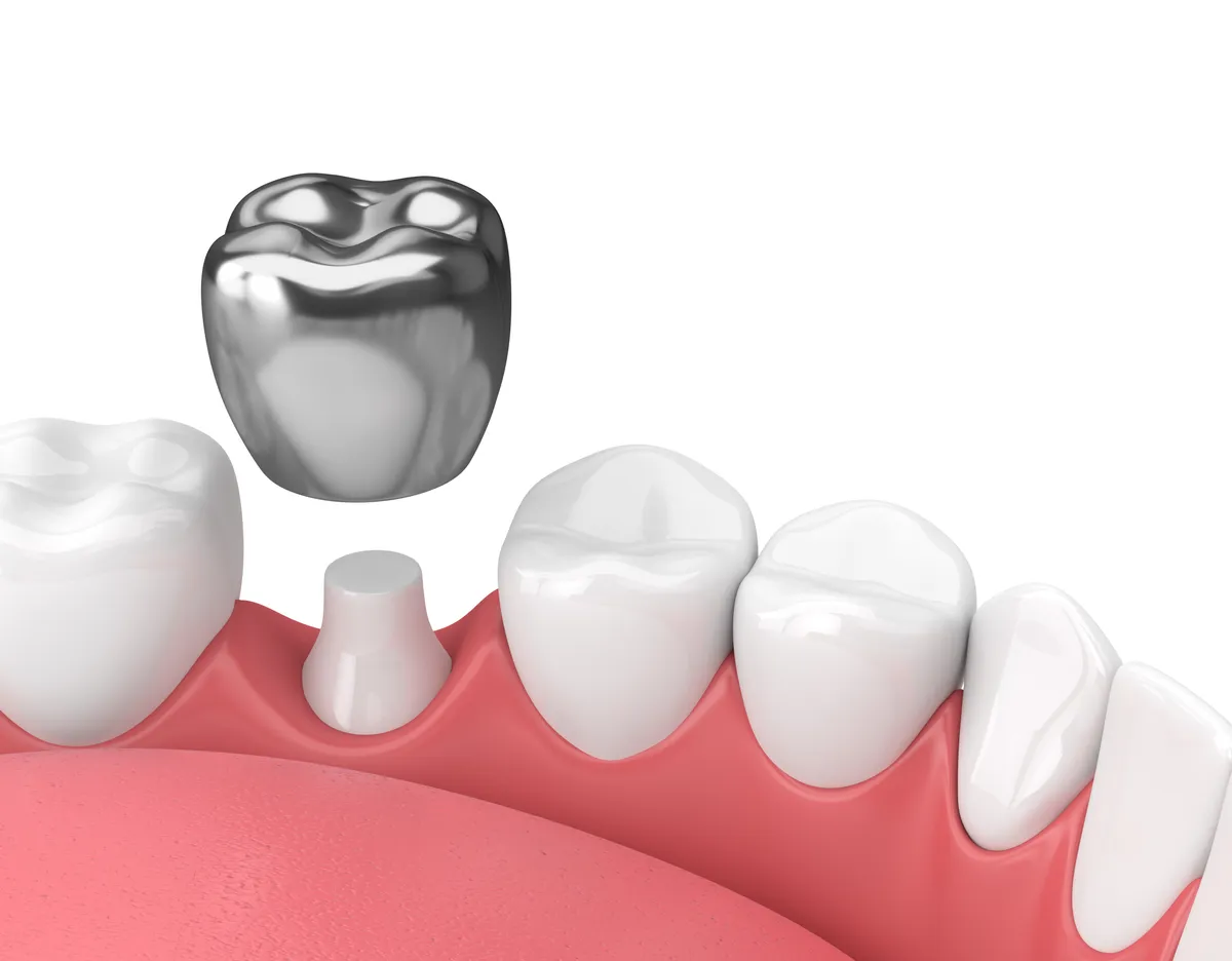 Dental Crowns: Types, Procedure, Care & Costs – NewMouth