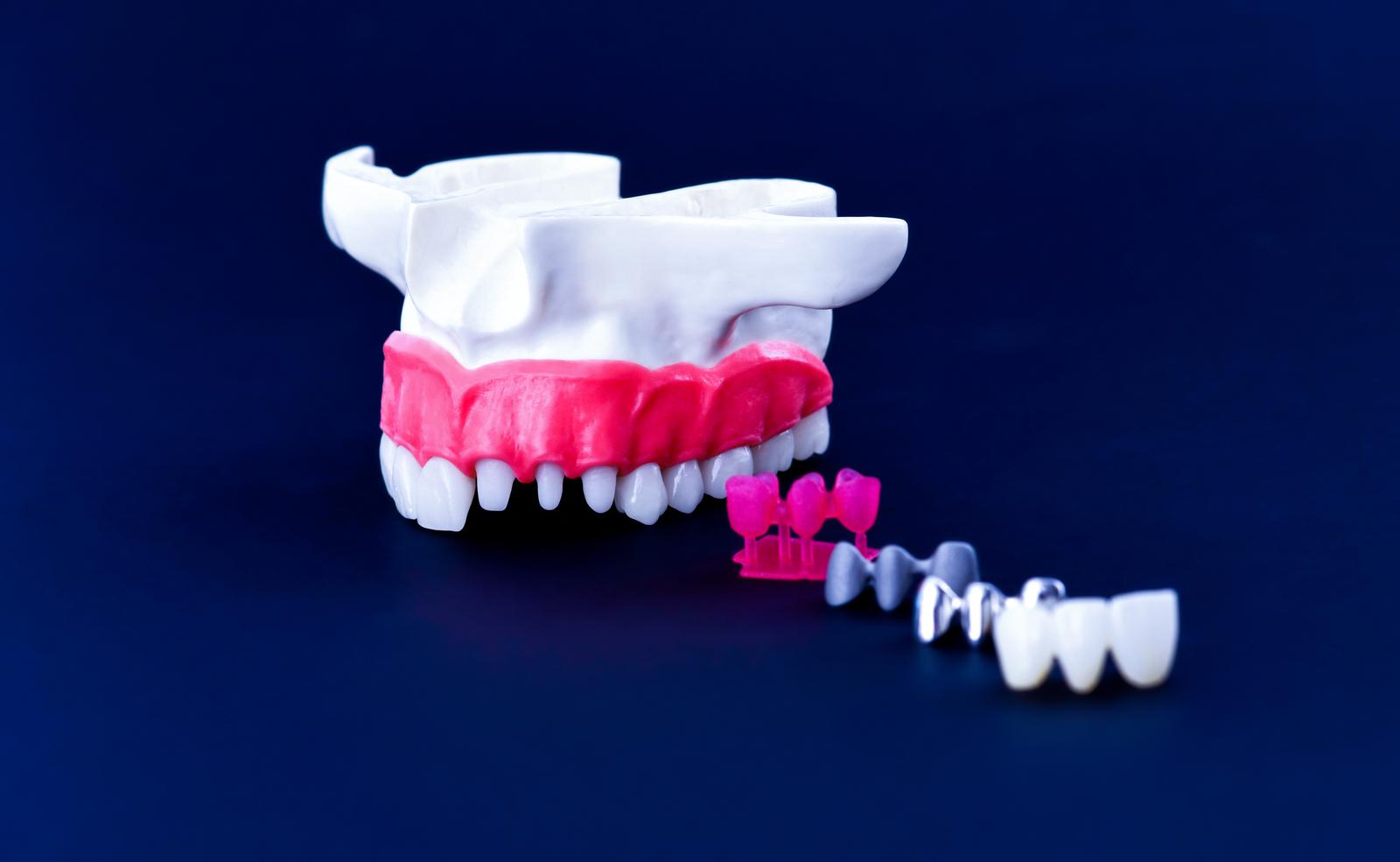Veneers Vs Crowns Which Is Best For You NewMouth veneers-vs-crowns-which-is-best-for-you-newmouth