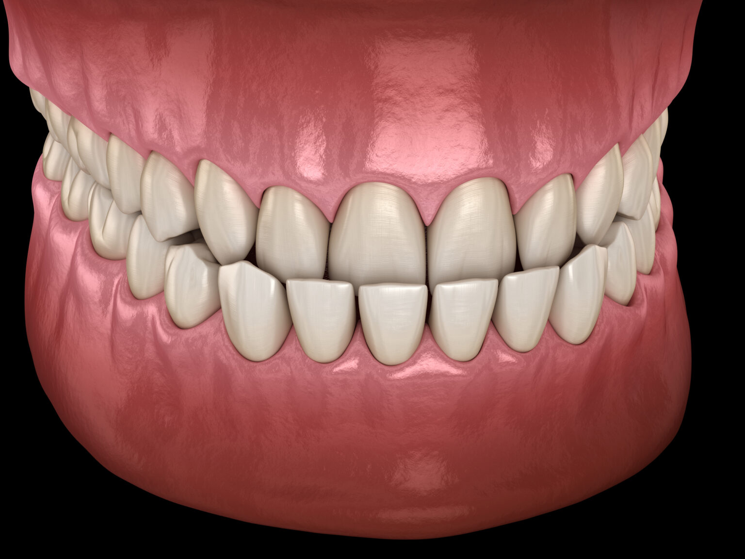 Underbite (Treatment and Correction Options)