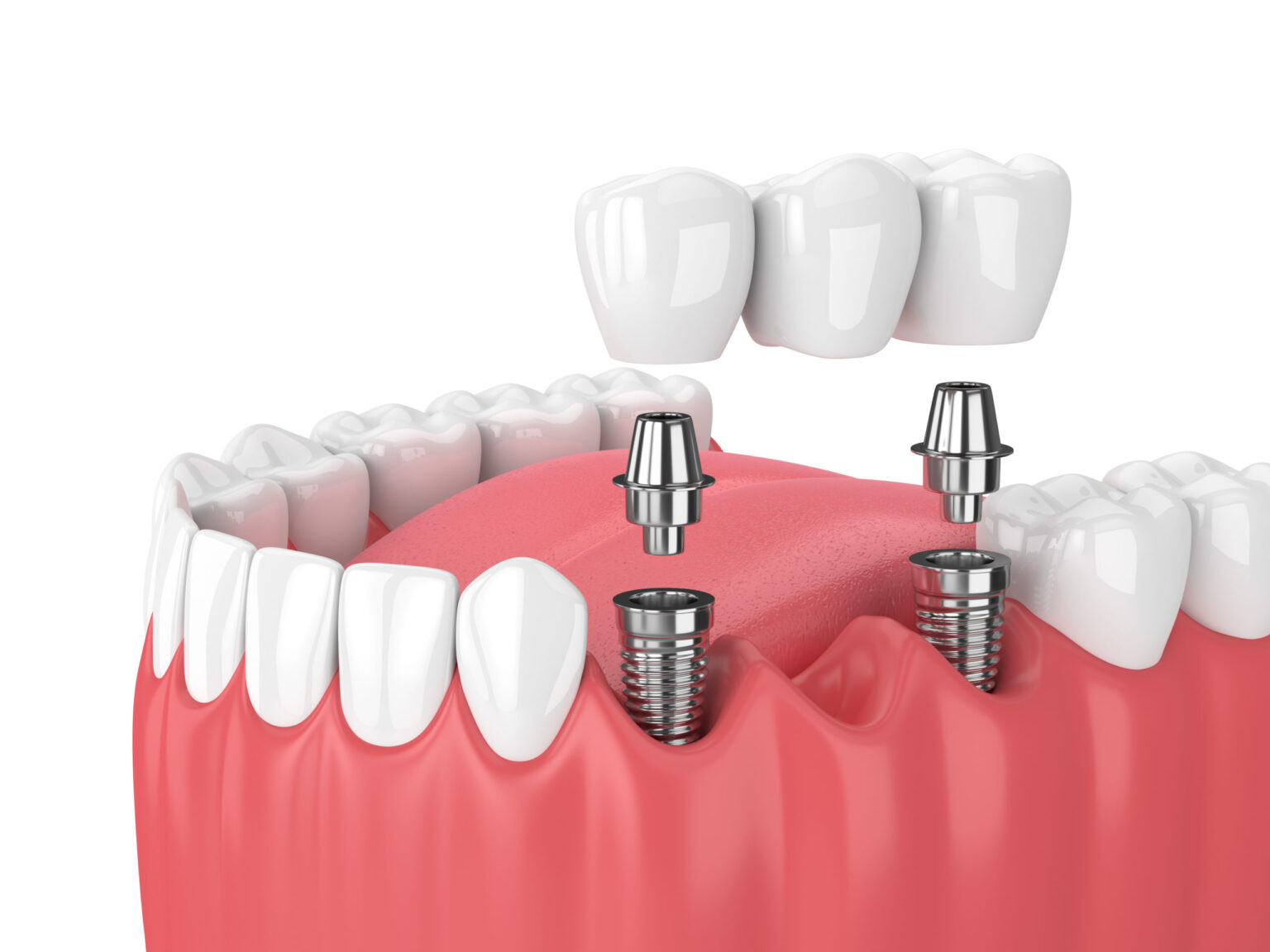 Partial Dentures: Cost, Types, Cleaning and More