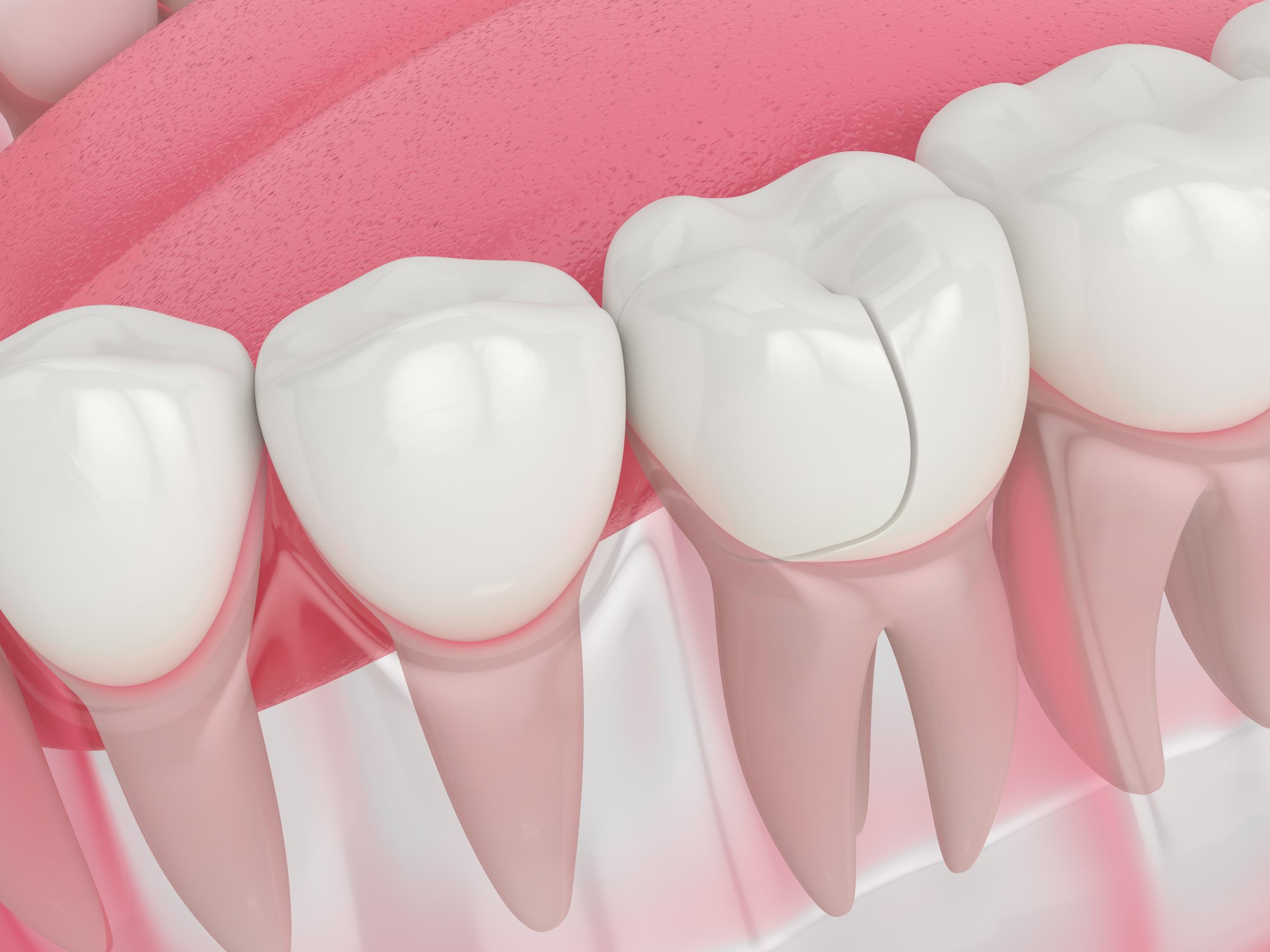 5 Types of Cracked Teeth (Pain Relief & Treatment)
