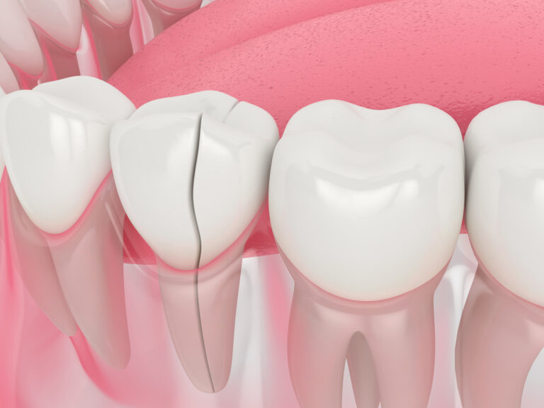 5 Types of Cracked Teeth (Pain Relief & Treatment)