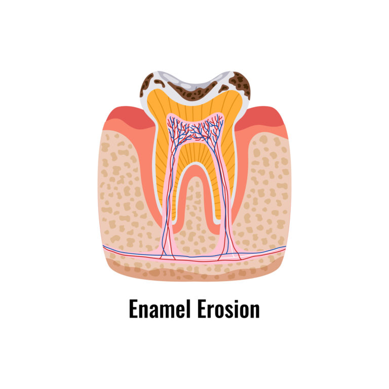 Tooth Enamel Erosion (Causes, Symptoms & Treatment Costs)
