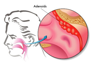 Adenoidectomy - Procedure, Recovery & Who Needs It?